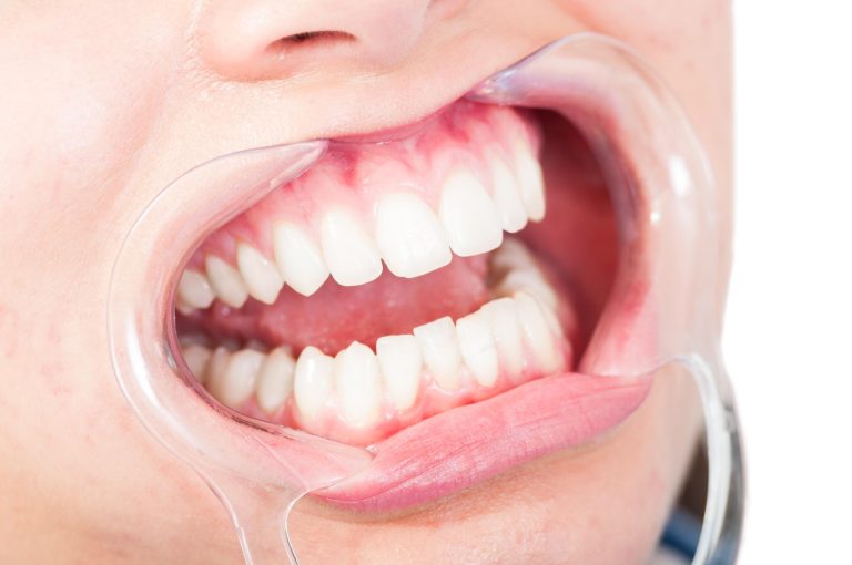 Can A Loose Front Tooth Be Saved? Here’s What You Need To Know