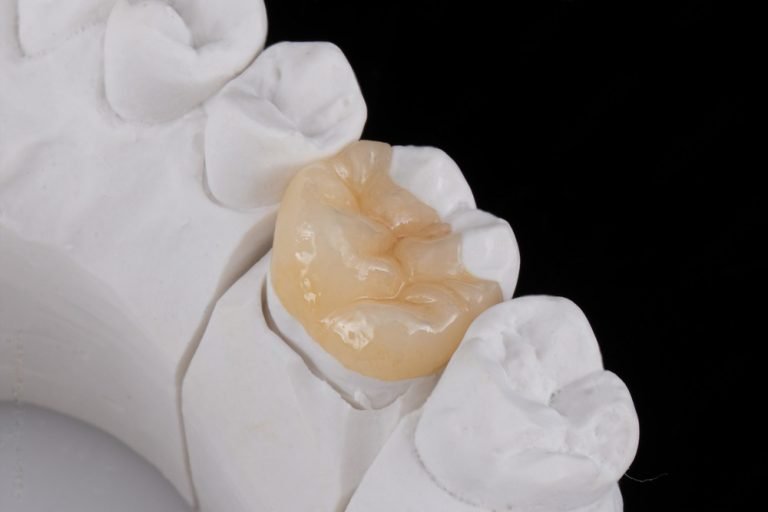 Dental Onlay Vs Filling: What’s The Best Choice For Your Smile?